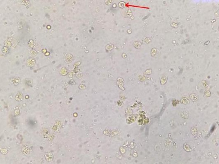 Bênh lỵ amip là gì? Nguyên nhân, triệu chứng và cách điều trị