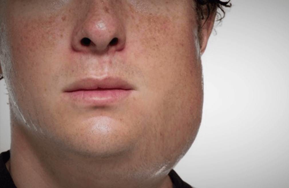 Quai bị là gì? Nguyên nhân, triệu chứng và cách điều trị ra sao?